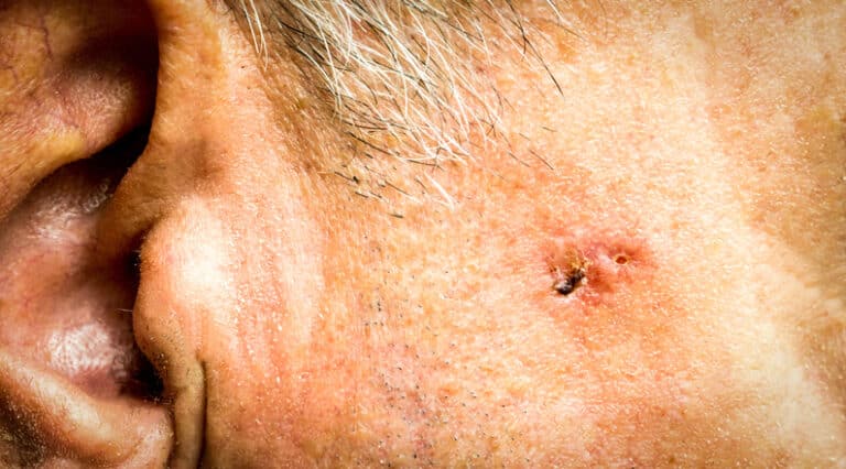 Traitement de cancer de la peau | clinique dermatologique à Bruxelles