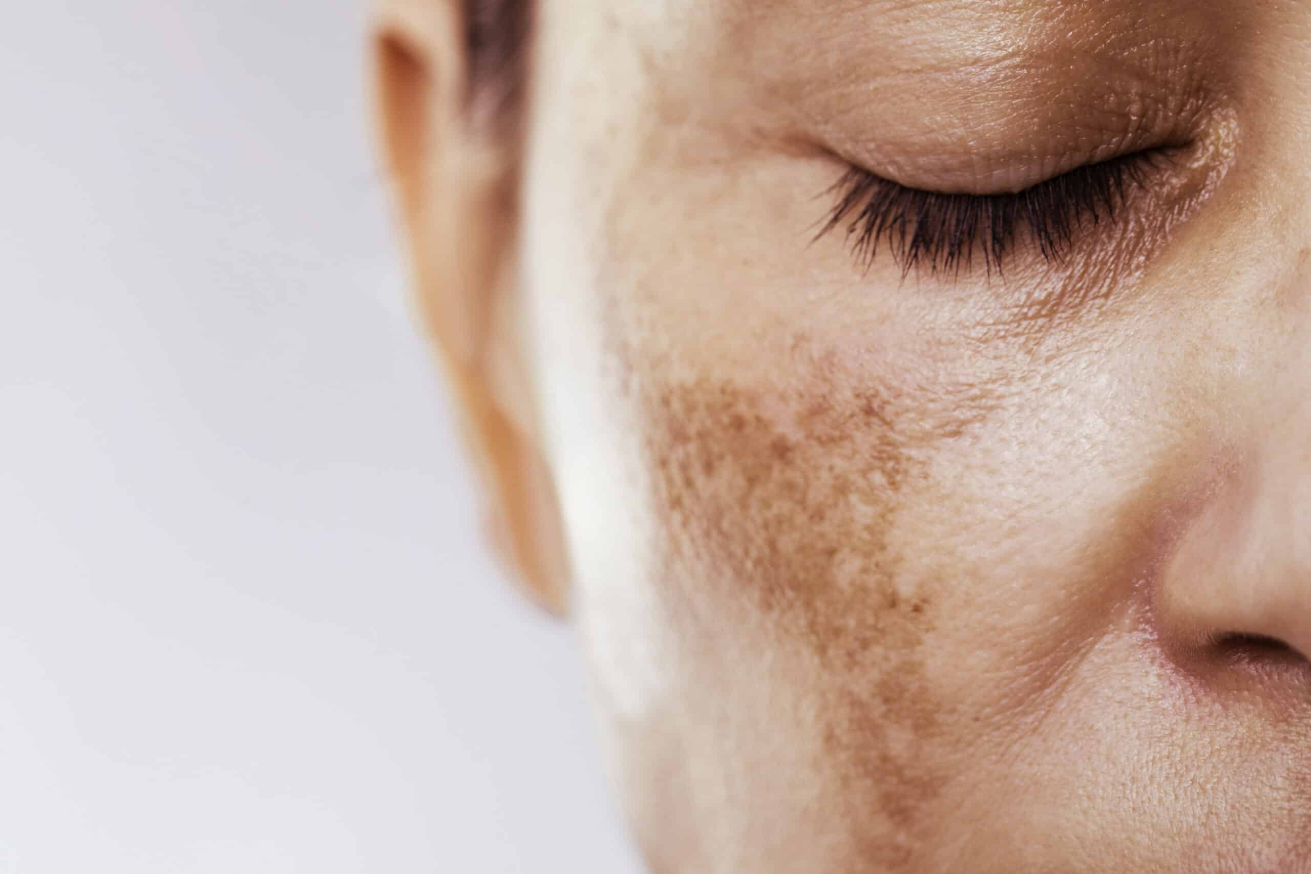 Troubles pigmentaires : comprendre et traiter - Dermatology Laser ...